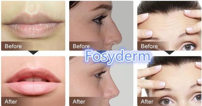 Facial Beauty Hyaluronic Acid Filler Injections Easy Operation For ...