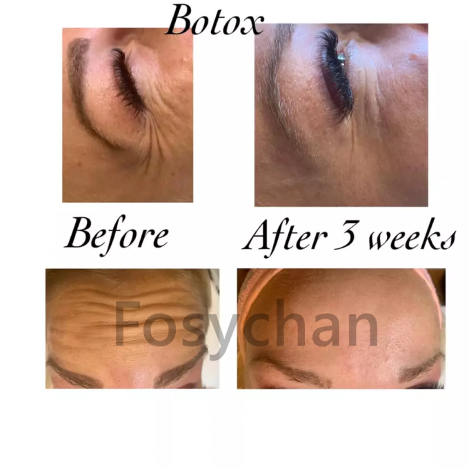 BTX Injection Botulinum Toxin Face Lift Powder Injection