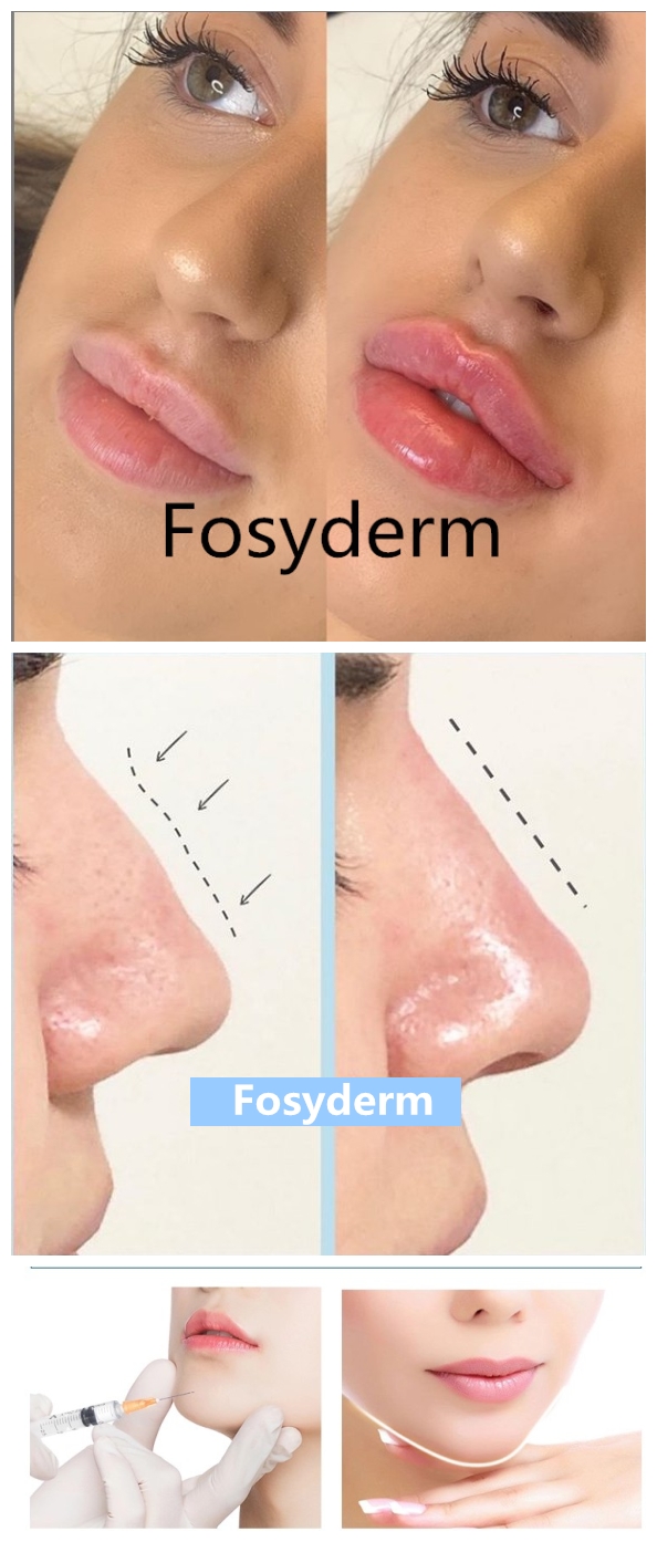 0.28mm 1ml 2ml Hyaluronic Acid Dermal Lip Fillers