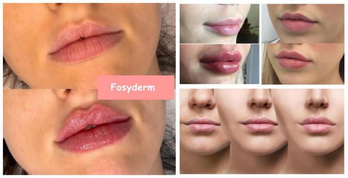 2ml Dermal Cross Linked Hyaluronic Pen Fillers