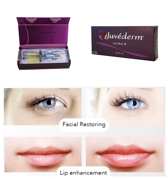 Allergan Ultra 4 Hyaluronic Acid Dermal Filler 2ml Lip Chin Cheek ...