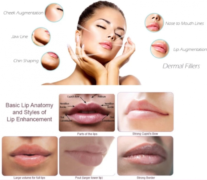 Juvederm Ultra 3 1 Ml * 2 Hyaluronic Acid Dermal Filler Lip Injections