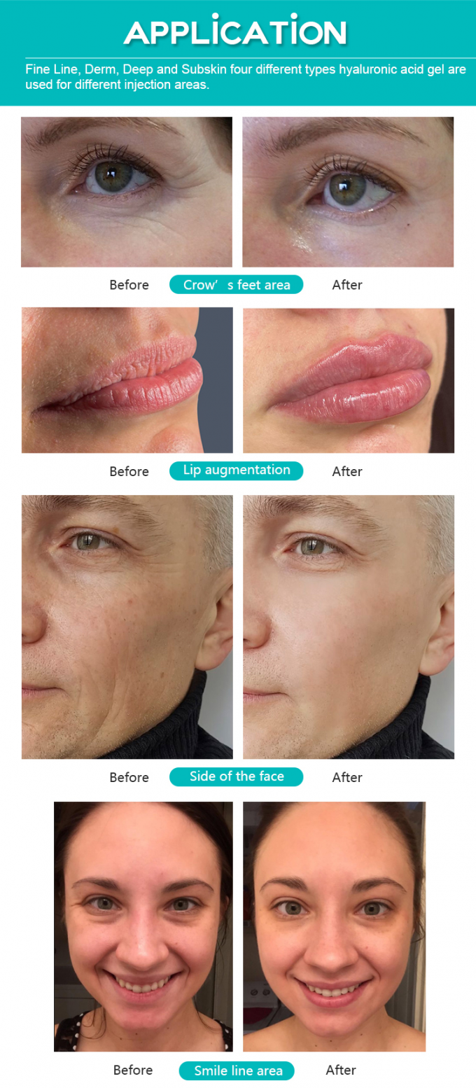 2 ml Injectable BDDE Hyaluronic Acid Dermal Filler For Wrinkles Lips ...