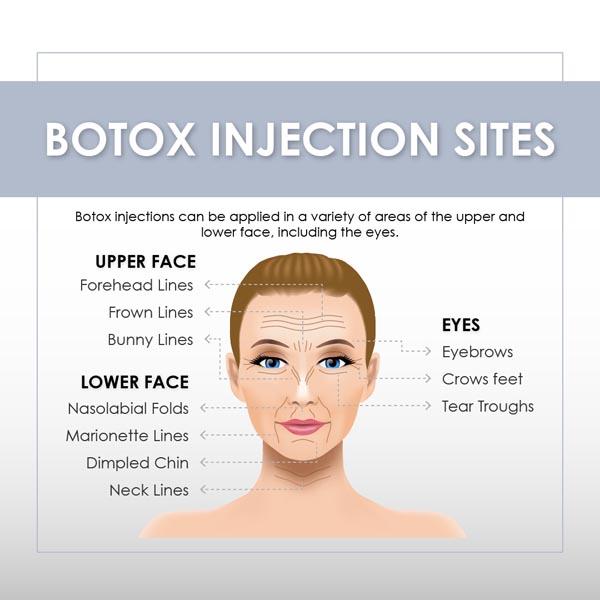 Allergan Injectable For Forehead Wrinkles Botulinum Toxin 100 Units