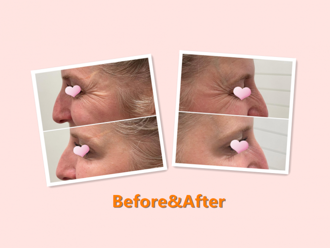 White Allergan Botulinum Toxin Anti Aging Injection