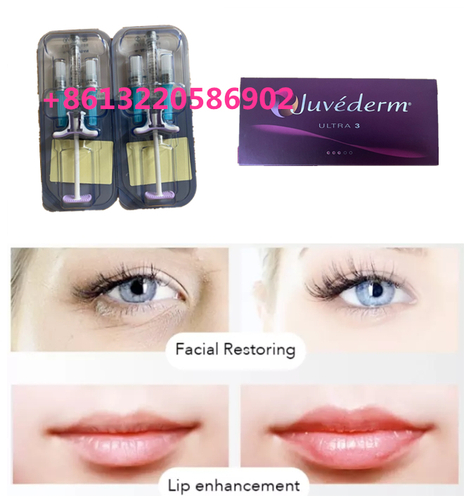 Juvederm Ultra Voluma Hyaluronic Acid Lip Augmentation Fillers 2x1ml/Box