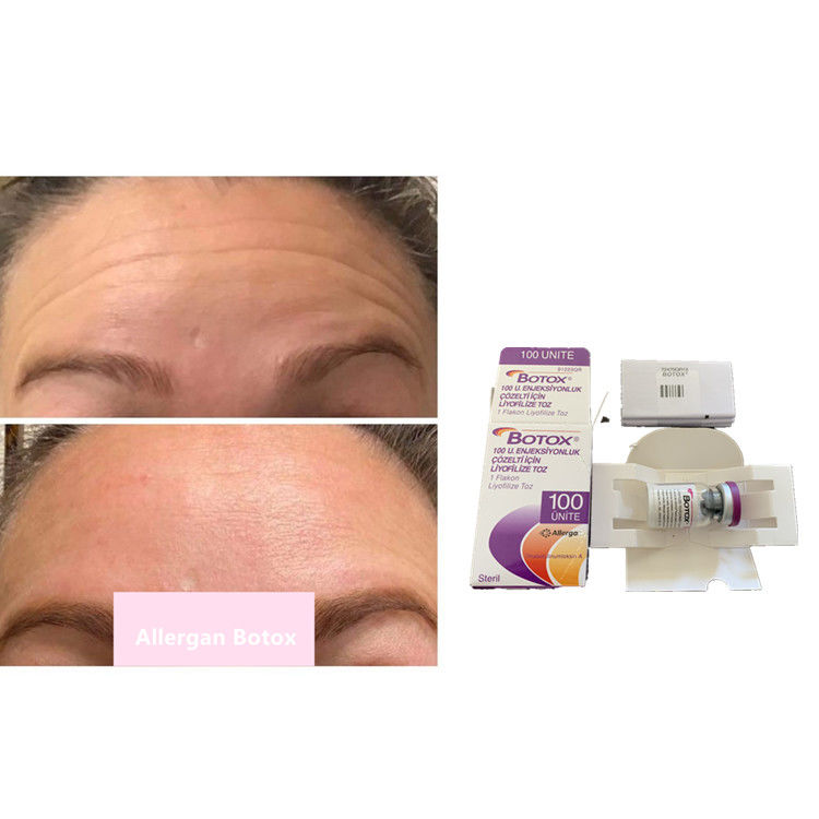Wrinkle Removal 100units Allergan Botox Botulinum Toxin Powder Injection