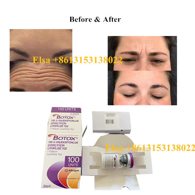 Allergan Botoxs Type A 100units Botulium Toxine Anti Aging Injection