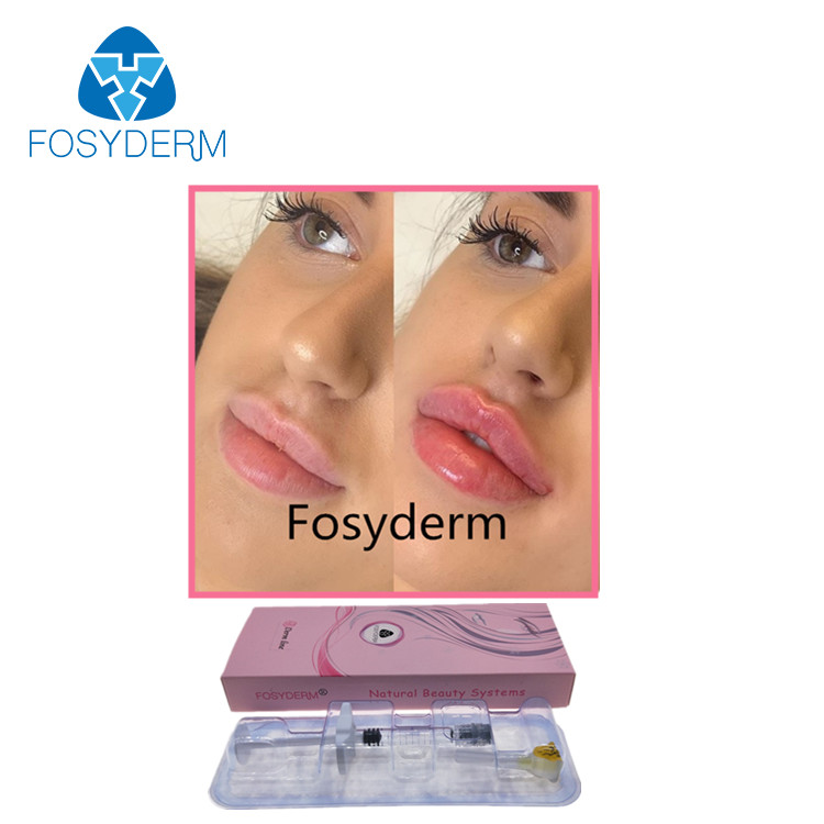 Fosyderm Aesthetics 1ml Hyaluronic Acid Injection Dermal Filler For Lips Enhancement