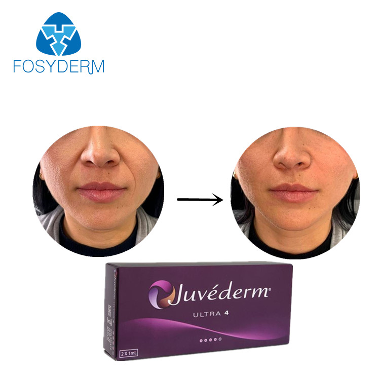 Juvederm Cross Linked Hyaluronic Acid Dermal Filler Allergan Ultra 4 Juvederm Cross Linked Hyaluronic Acid Dermal Filler Allergan Ultra 4