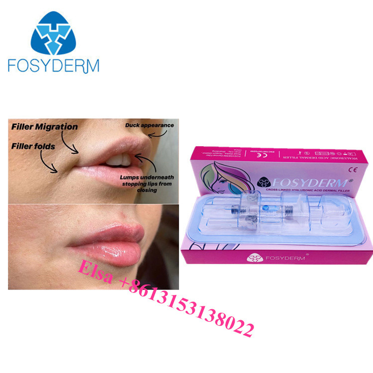 Lip Cheek And Nasolabial Dermal Filler Hyaluronic acid Ha Injections ...