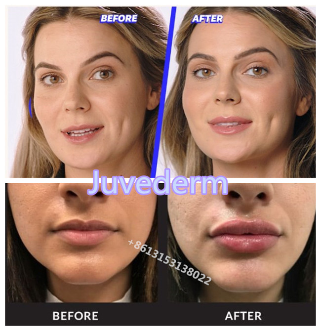 Voluma / Ultra Juvederm Dermal Fillers Juvederm Syringe With Lido