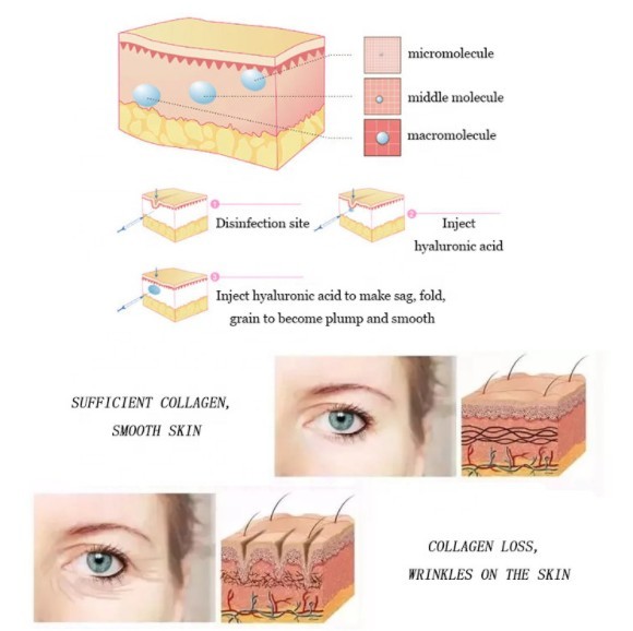 Cross Linked Hyaluronic Acid Dermal Filler HA Gel Injection With Lidocaine