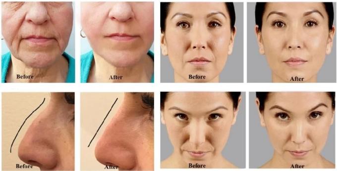 Deep Dermal Cross Linked Hyaluronic Acid Nose Filler 24mg/ml